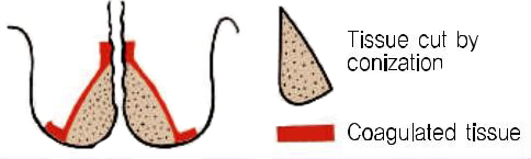 RADIO FREQUENCY ELECTROSURGICAL DEVICE - Avs